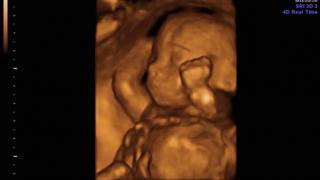 partial birth abortion | MRCTV